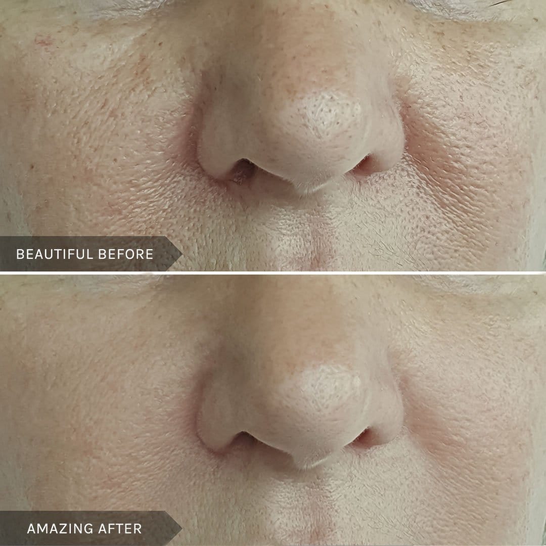 Retinew Peel Mask 4pce Kit- Retinol/Lactic Acid/Rosehip Oil 5g/0.17oz ...